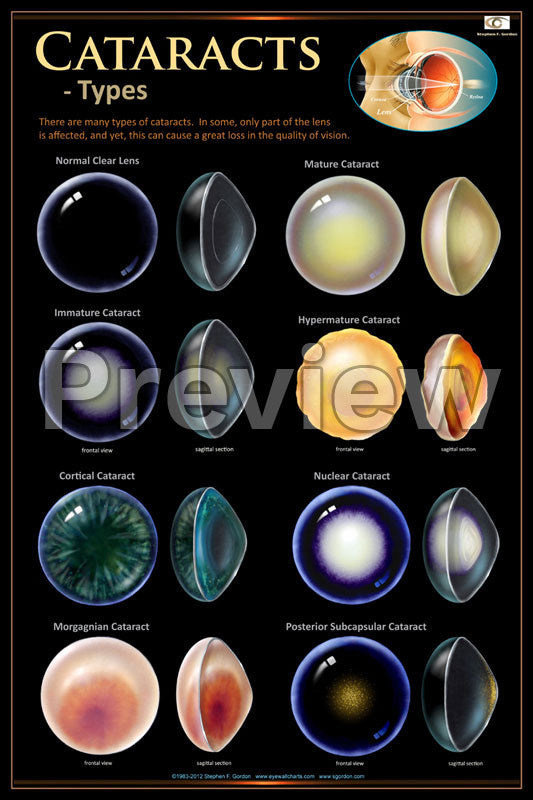 Cataract Types Poster – Eye Flip Charts by Stephen F. Gordon