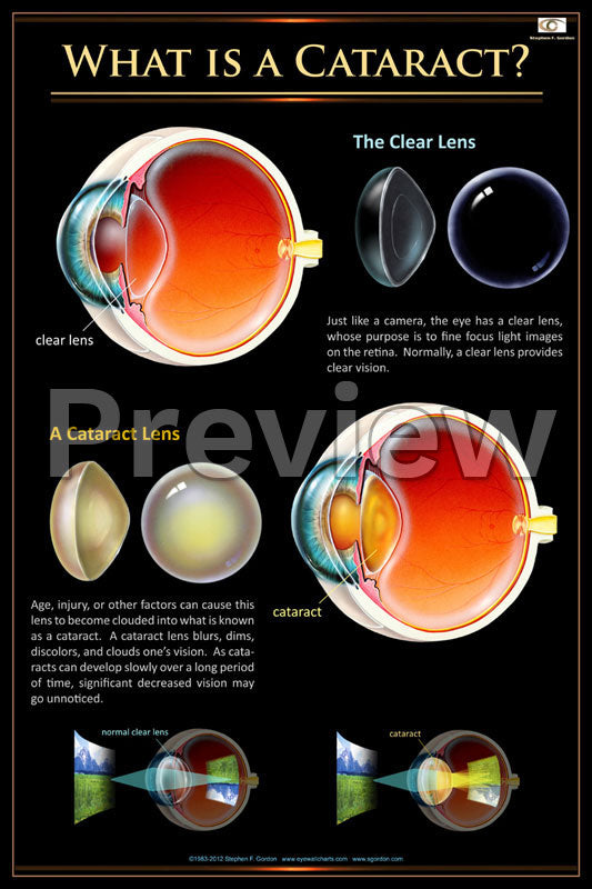 Cataract Overview Poster – Eye Flip Charts by Stephen F. Gordon